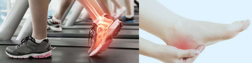 Heel Spurs: Calcaneal Spur Causes and Treatments