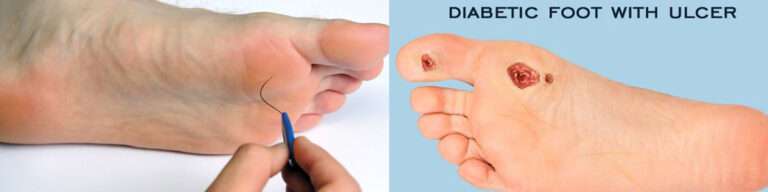 Diabetic Foot Problems: Symptoms and Treatment | Boyner Clinic