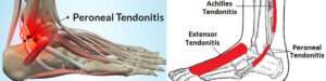 Peroneal Tendonitis: Causes and Treatments