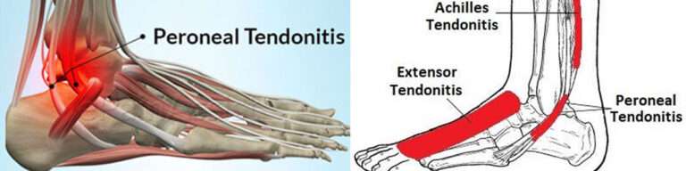 Peroneal Tendonitis: Causes and Treatments